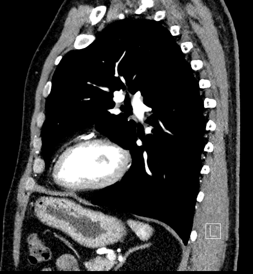 Ct-scan-thorax